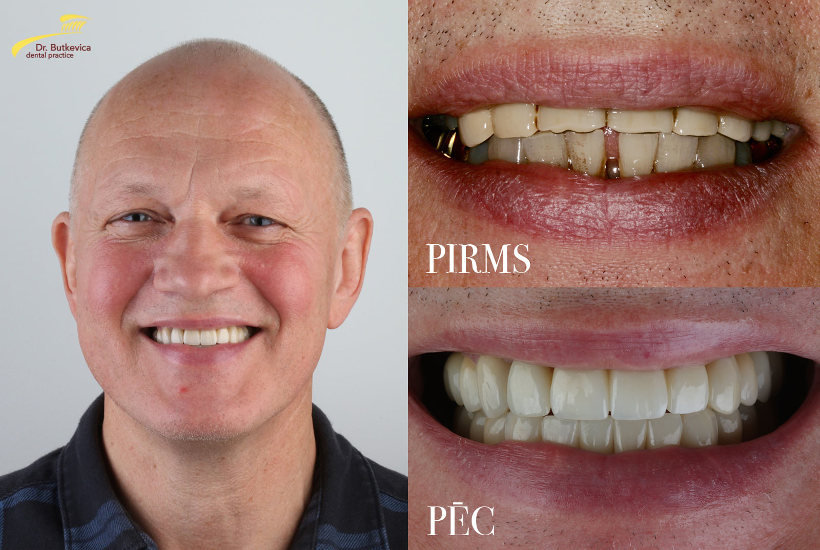 Laba zobārstniecība Rīgā ikvienam | Butkevicadental.com